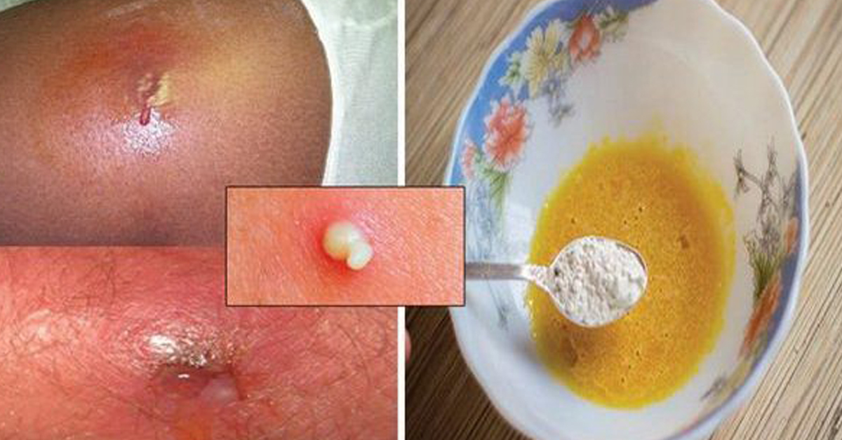 Домашнее средство, которое вытащит гной из ран и язв! Эффективно ...